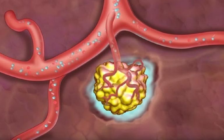 Metastazat dhe tumoret/ Përhapja, simptomat dhe trajtimet - Me Mjekun