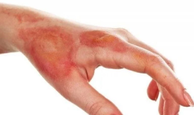 Nekroza e lëkurës, shkaqet dhe diagnoza - Me Mjekun