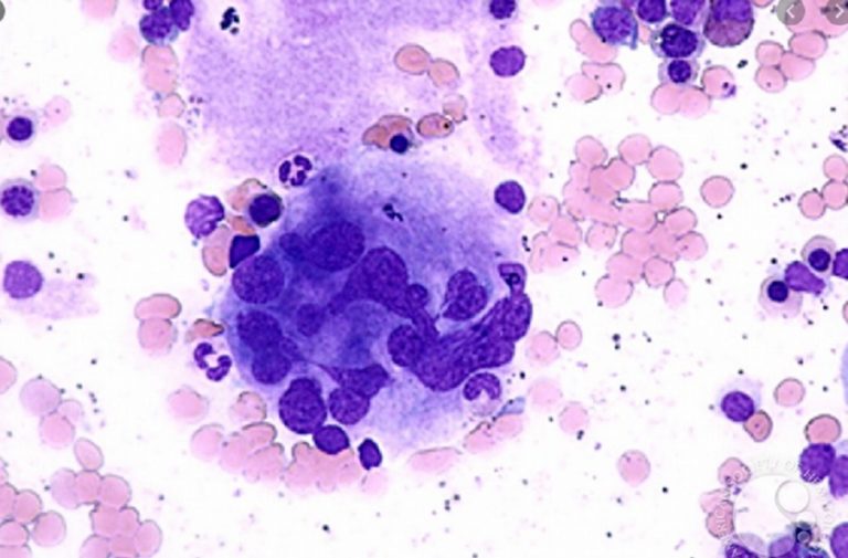 Trombocitemia esenciale, shkaqet dhe trajtimi - Me Mjekun