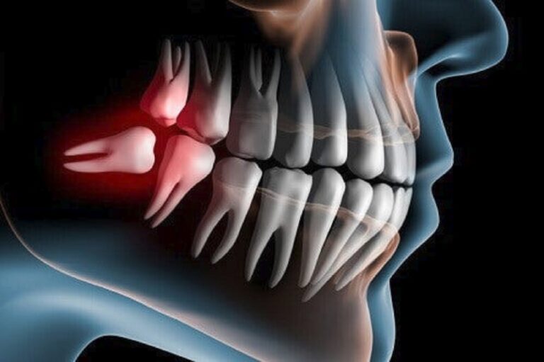 Dentitio difficilis, kur del keq dhëmballa e pjekurisë. Simptomat dhe ...